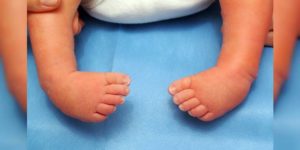 Congenital Talipes Equinovarus (Clubfoot) - Orthoist